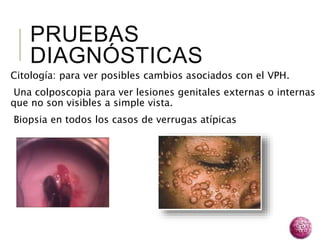 virus del papiloma humano | PPTX