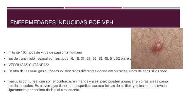 virus del papiloma humano (VPH)