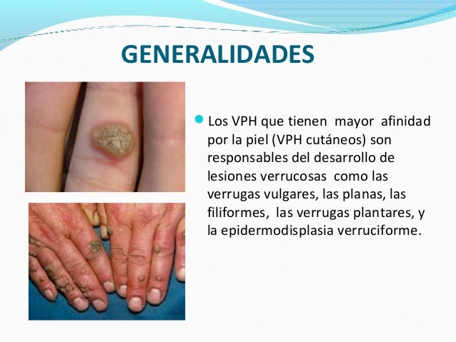 Vph en adolescentes