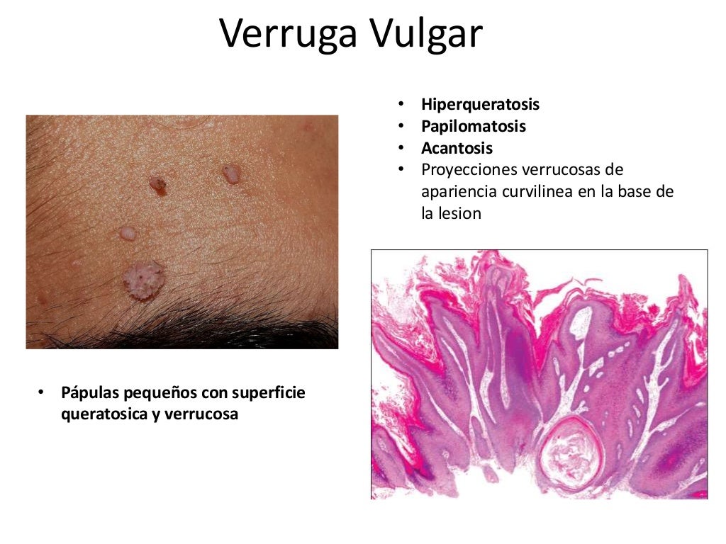 Vph histopatologia
