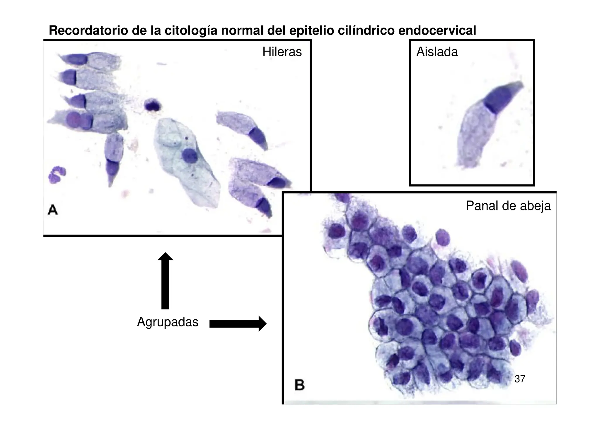 VPH y alteraciones epieliales citologia ginecologica | PPT