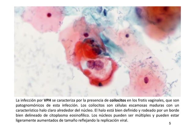 VPH y alteraciones epieliales citologia ginecologica | PPT