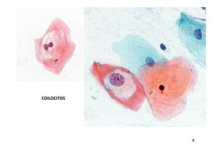 VPH y alteraciones epieliales citologia ginecologica | PPT