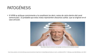 VÉRTIGO POSTURAL PAROXÍSTICO BENIGNO | PPTX