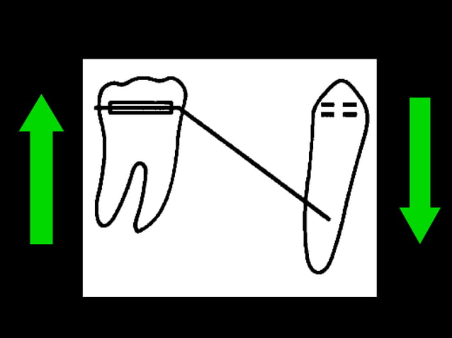 V bend principle | PPT | Dental Health | Diseases and Conditions