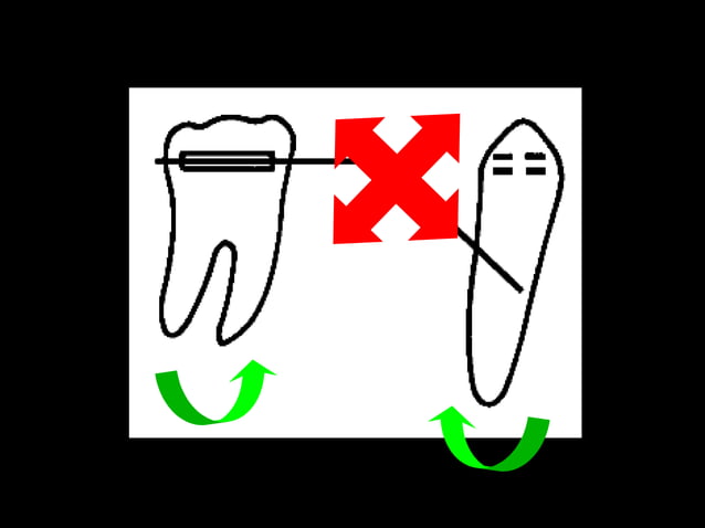 V bend principle | PPT | Dental Health | Diseases and Conditions