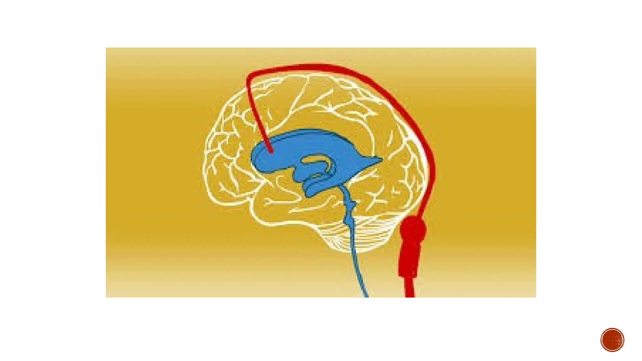 VP (ventriculoperitoneal shunt)shunt ..pptx
