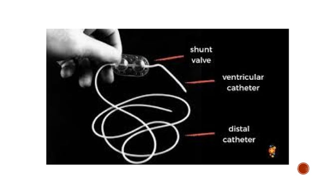 VP (ventriculoperitoneal shunt)shunt ..pptx