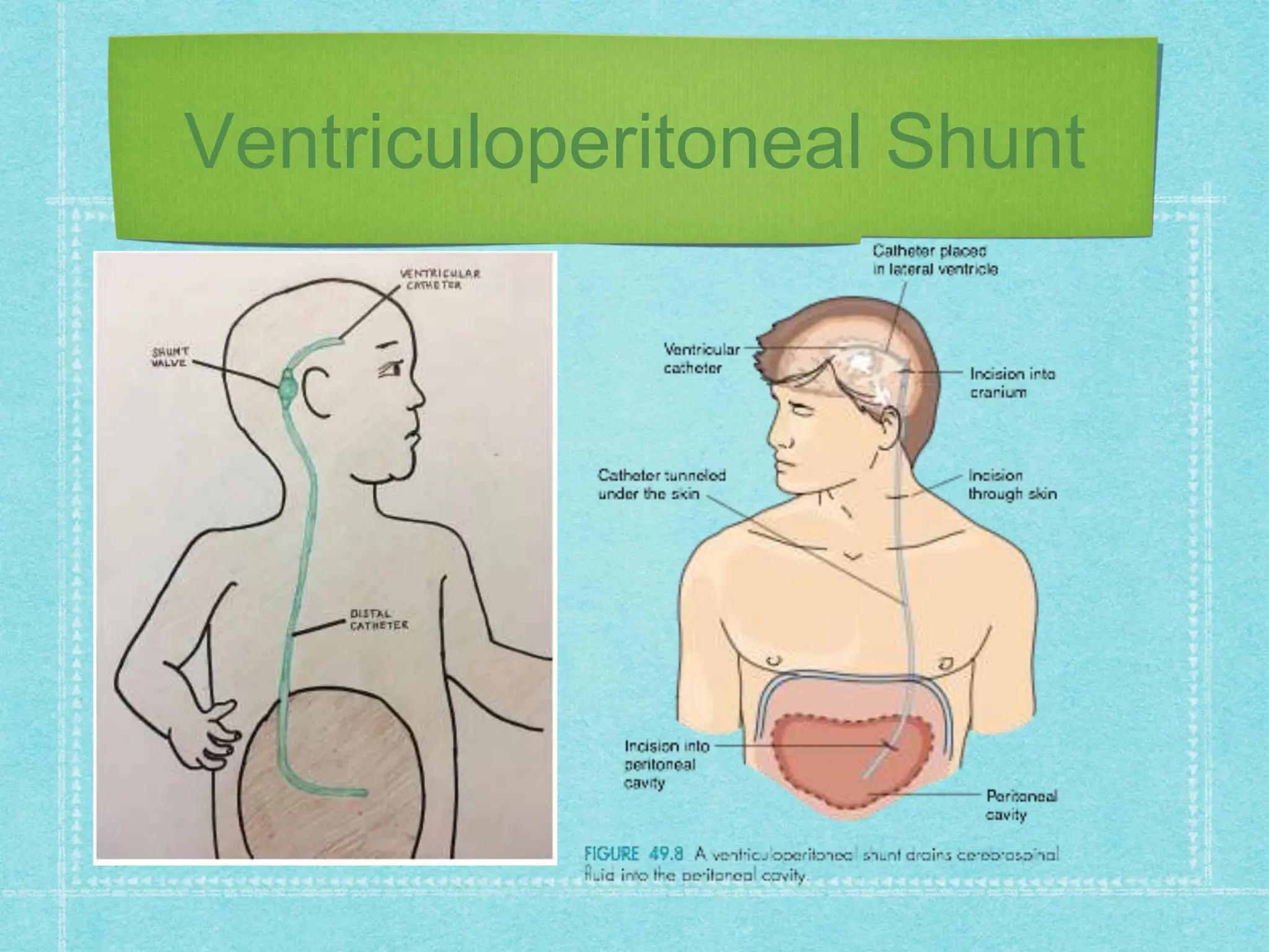 VP Shunt ppt.ppt medical surgical nursing | PPT