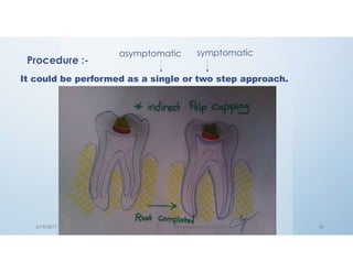 Management of incomplete root apex for vital tooth | PDF