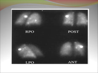 Lung Segments Vq