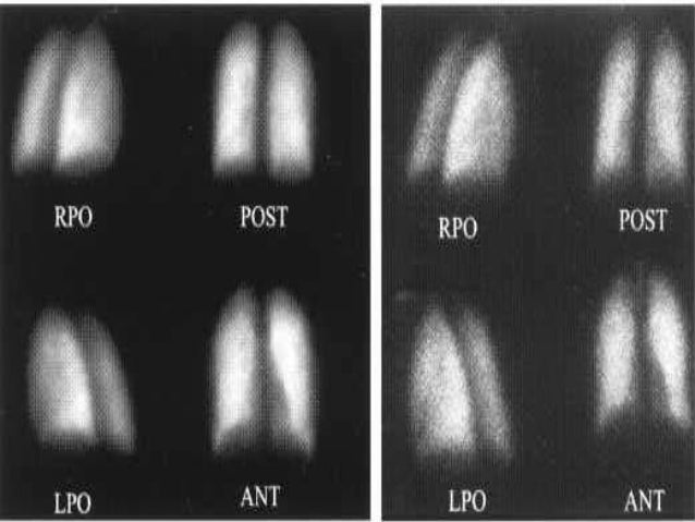 VQ scan of lung