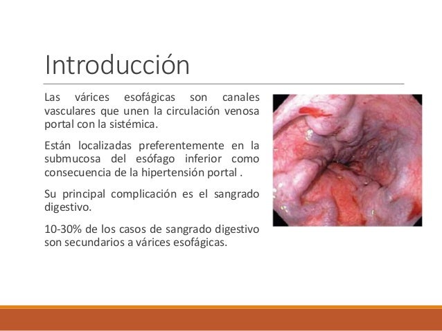 Várices esofágicas