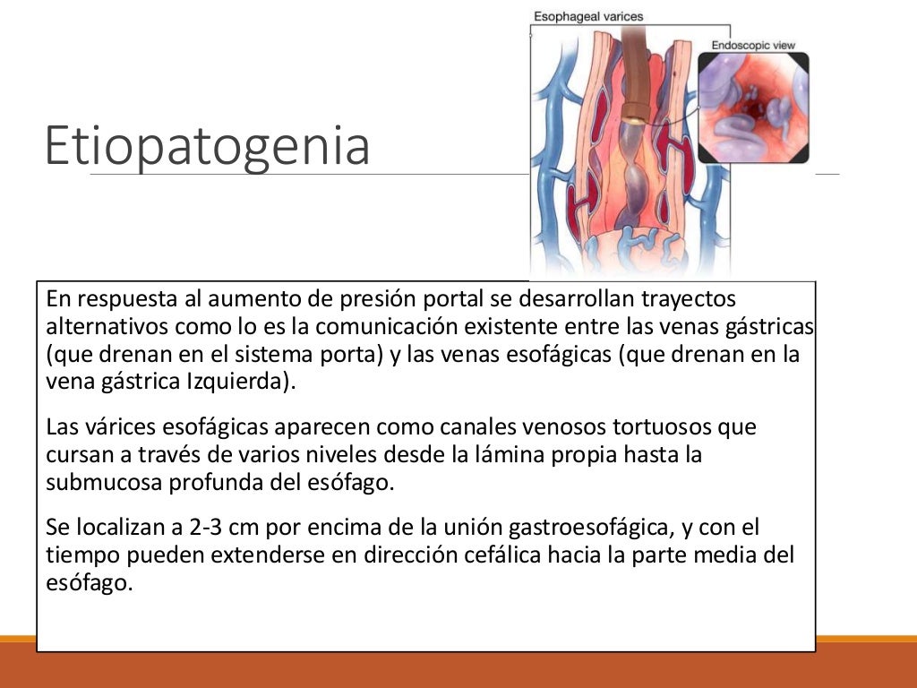 Várices esofágicas