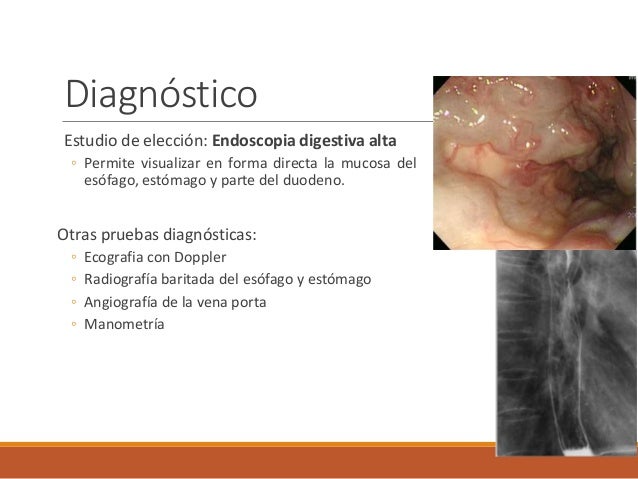 Várices esofágicas