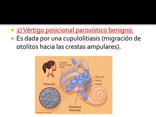 Vértigo central y periférico | PDF
