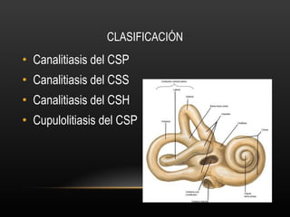 Vértigo postural paroxístico benigno | PPT