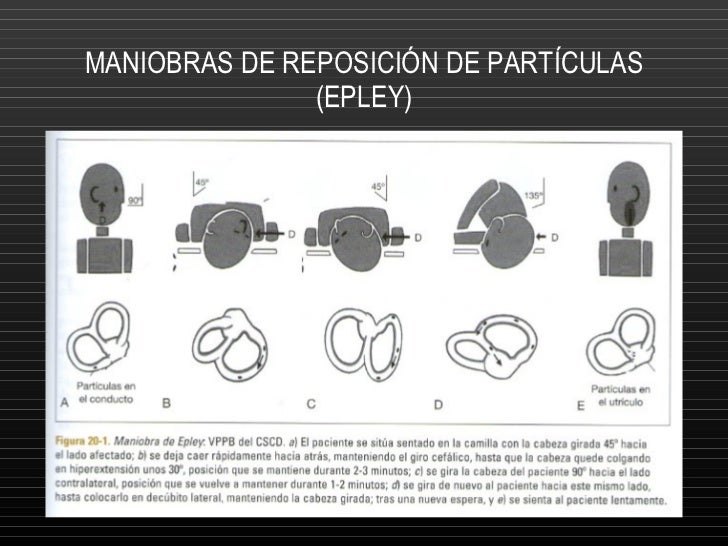 Vértigo postural paroxístico benigno