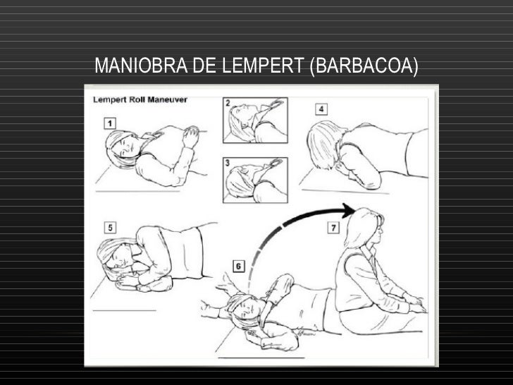 Vértigo postural paroxístico benigno