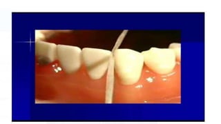 mechanical plaque control | PPT