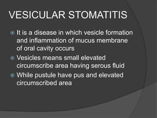 Vesicular stomatitis | PPTX
