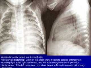 Ventricular Septal Defect X Ray