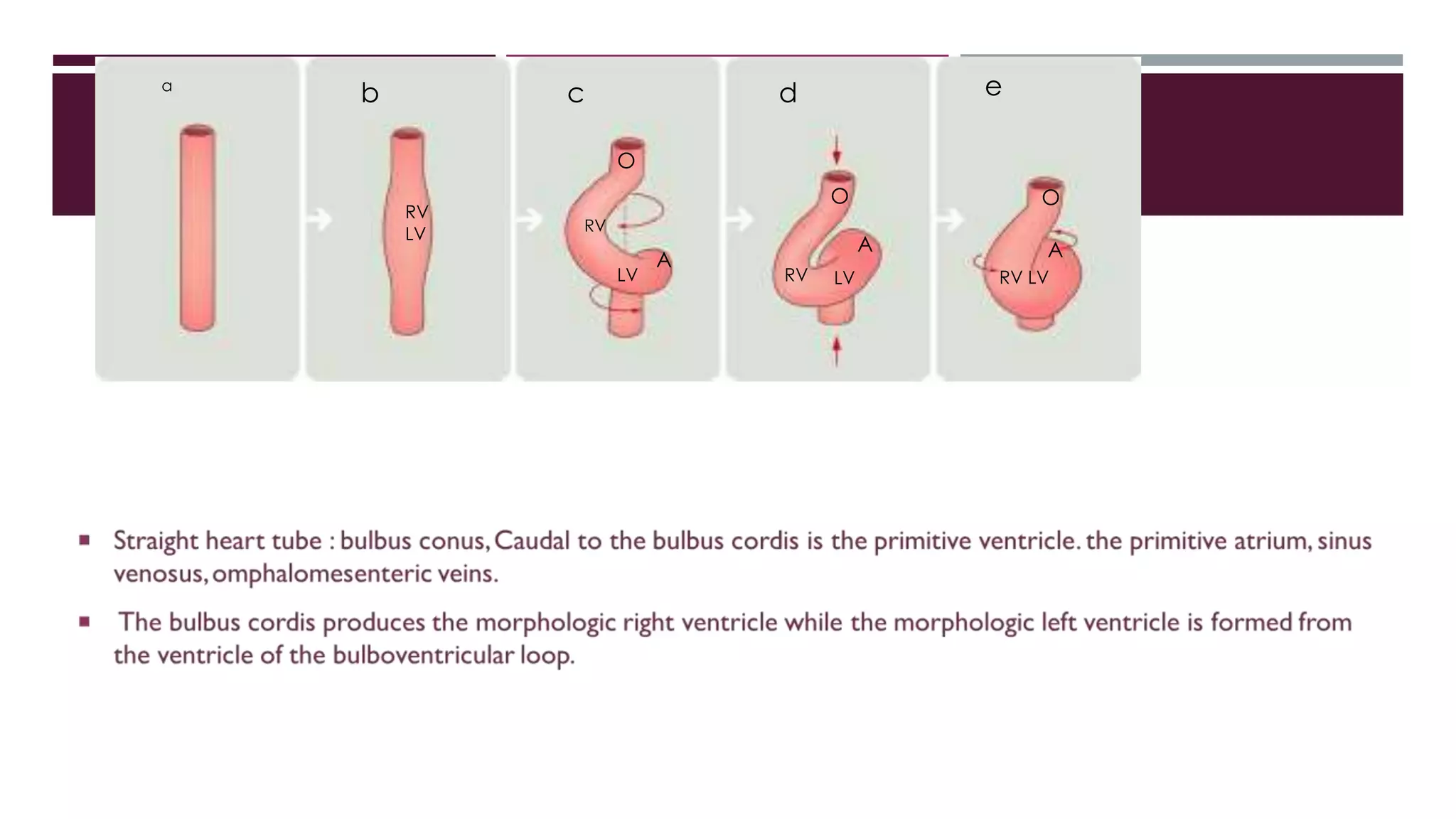 Ventricular septal defect, congenital heart disease | PPTX