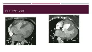 Ventricular septal defect, congenital heart disease | PPTX