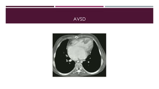 Ventricular septal defect, congenital heart disease | PPTX