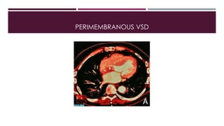 Ventricular septal defect, congenital heart disease | PPTX