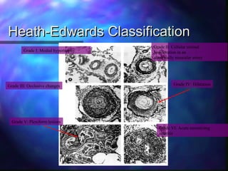VENTRICULAR SEPTAL DEFECT | PPT
