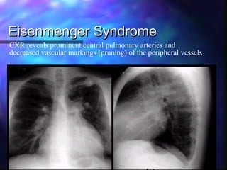 VENTRICULAR SEPTAL DEFECT | PPT