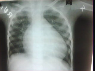 Ventricular Septal Defect X Ray