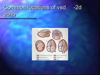 VENTRICULAR SEPTAL DEFECT | PPT