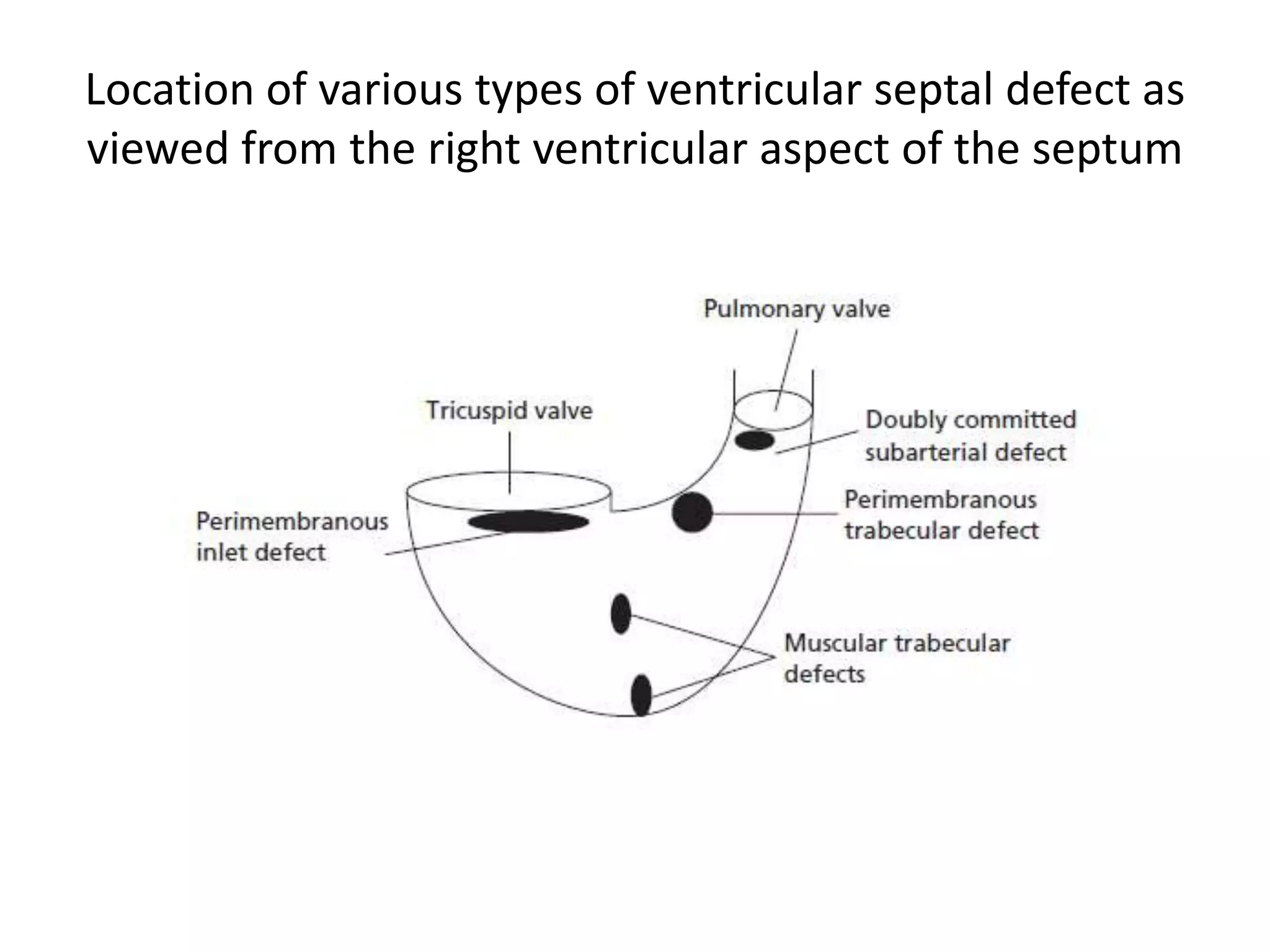 Ventricular Septal Defects - A Review | PPTX | Heart and Cardiovascular ...