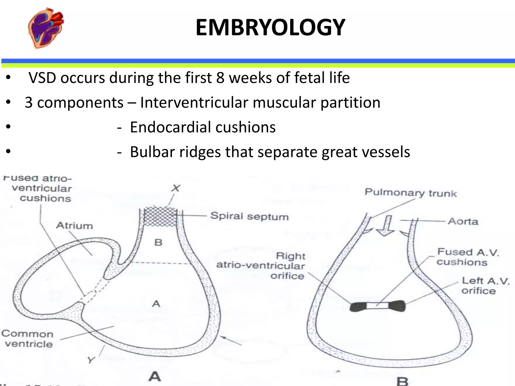 Ventricular Septal Defects - A Review | PPTX | Heart and Cardiovascular ...