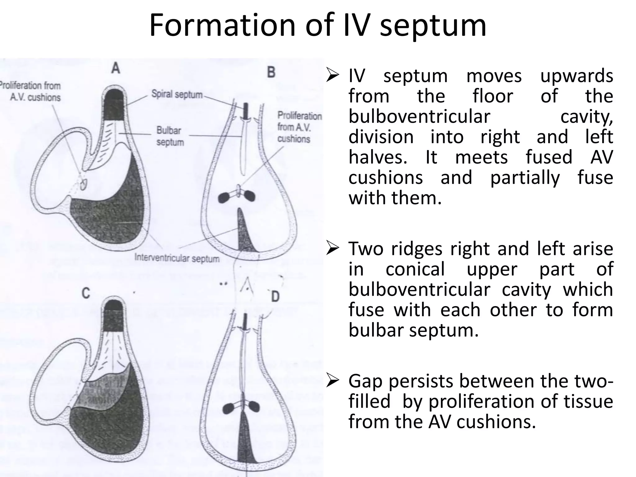 Ventricular Septal Defects - A Review | PPTX | Heart and Cardiovascular ...