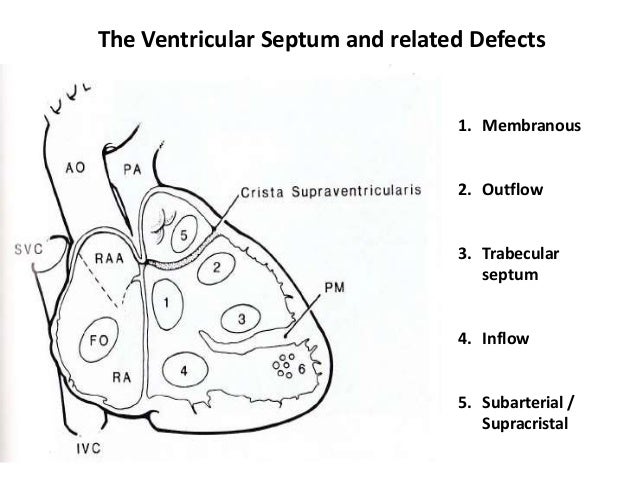 Ventricular Septal Defects - A Review