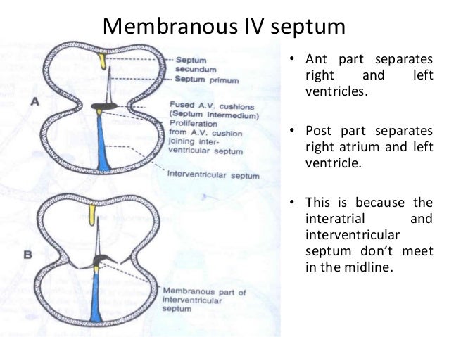 Ventricular Septal Defects - A Review