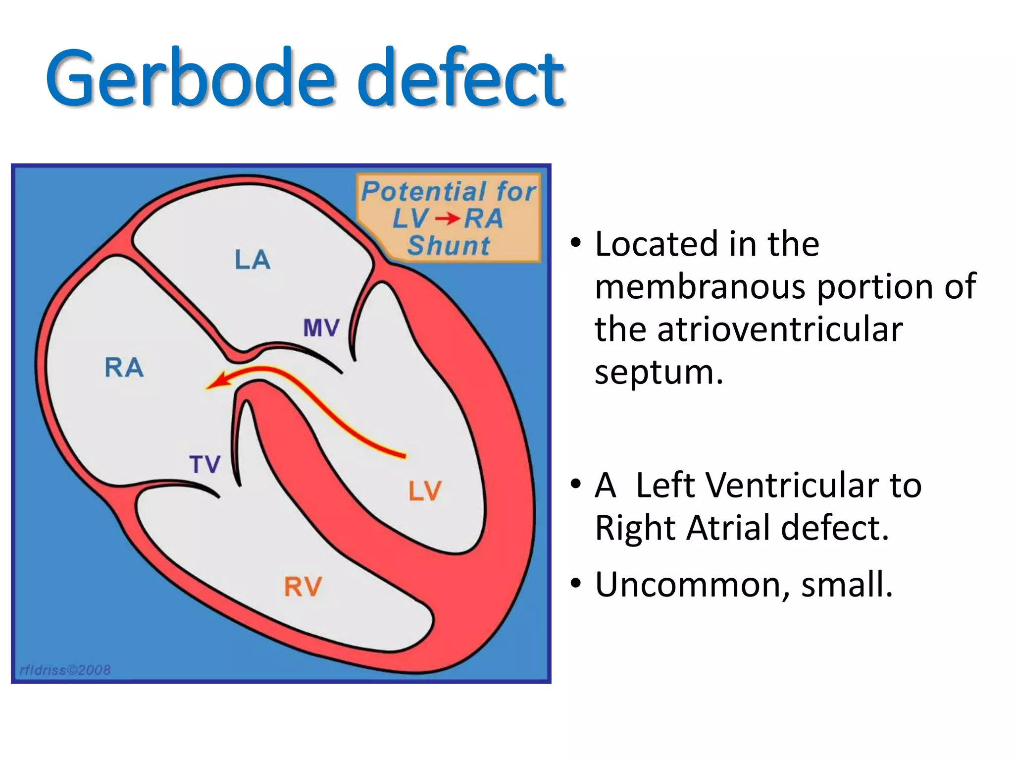 Ventricular Septal Defect | PPTX