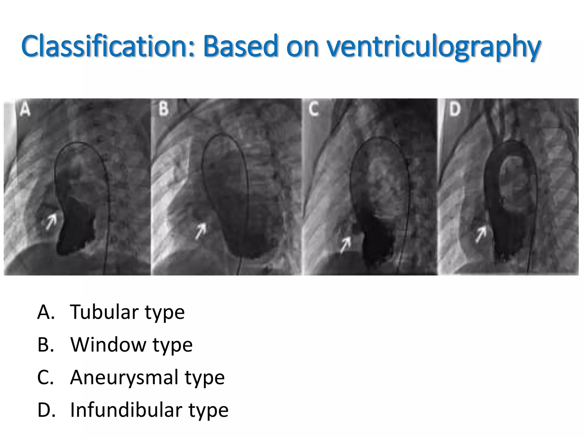 Ventricular Septal Defect | PPTX