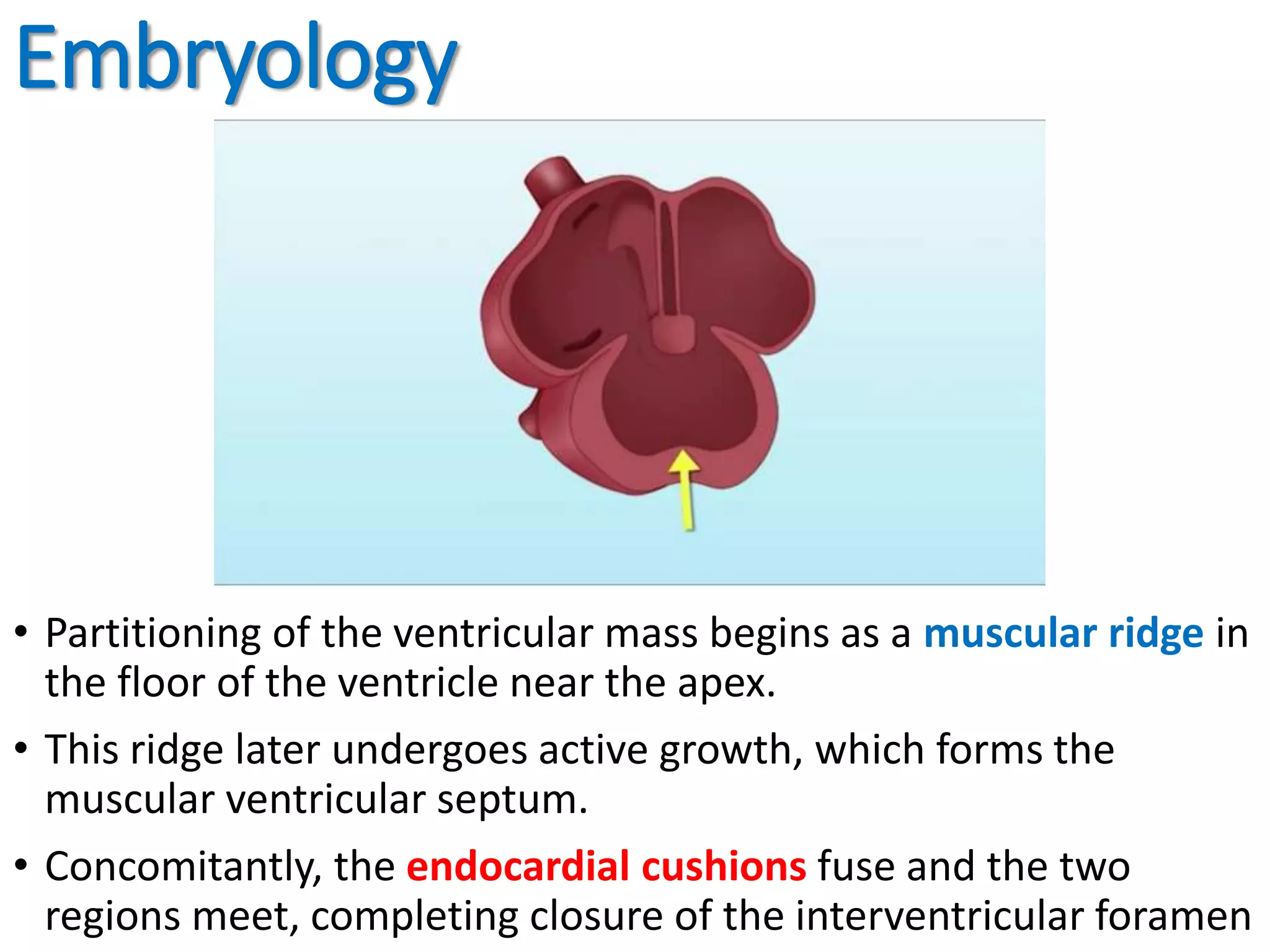 Ventricular Septal Defect | PPTX