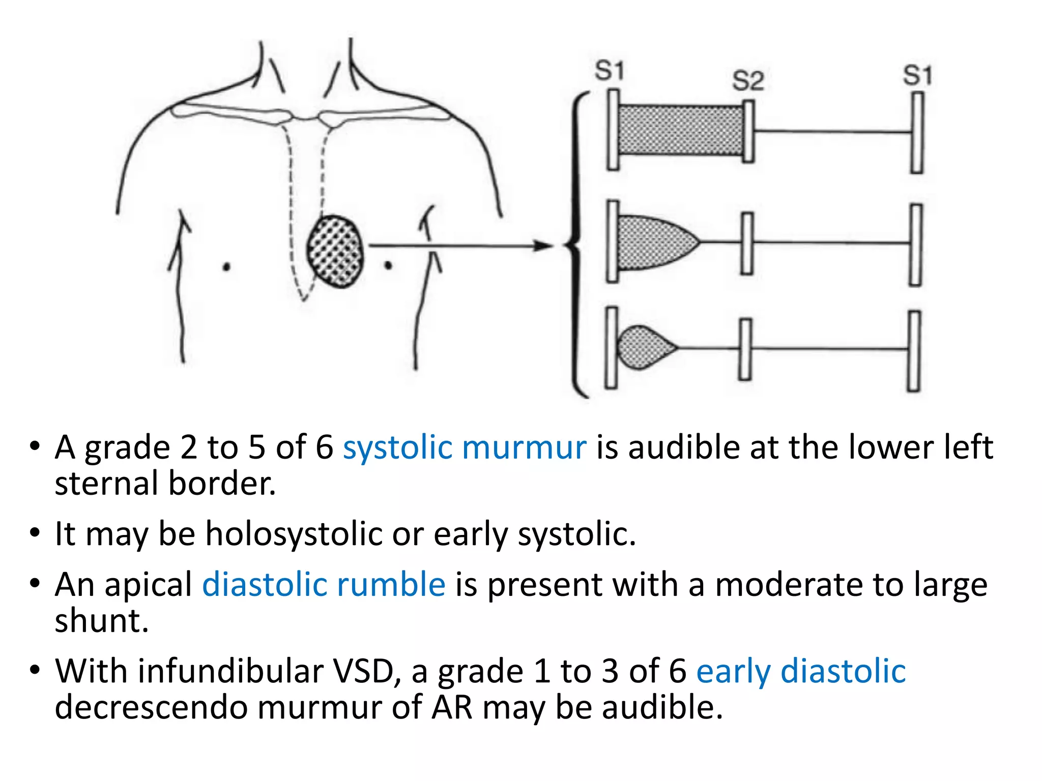 Ventricular Septal Defect | PPTX
