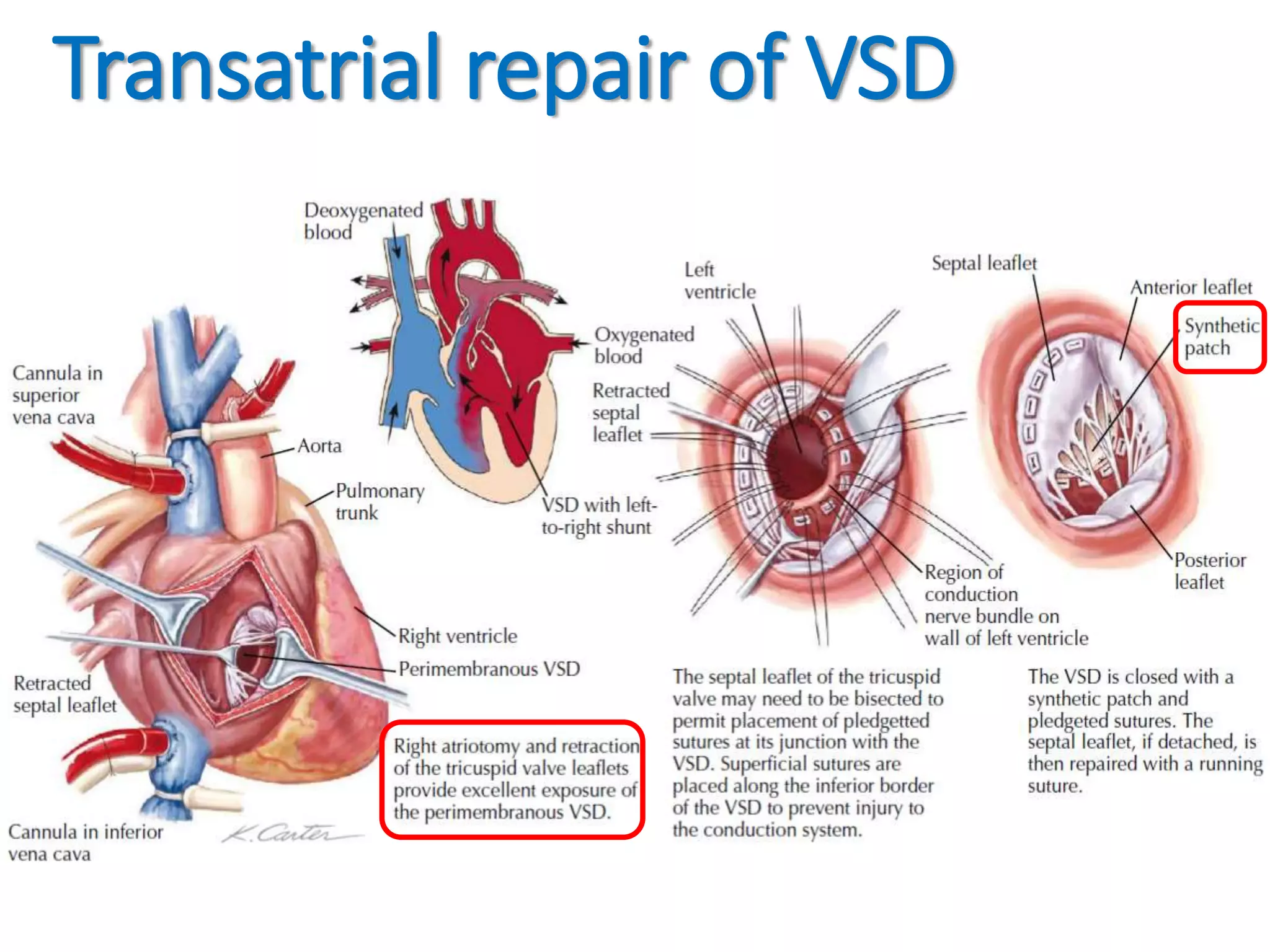 Ventricular Septal Defect | PPTX