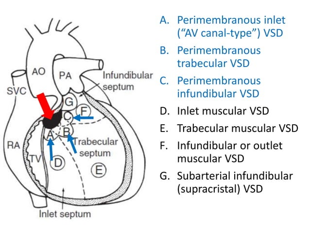 Ventricular Septal Defect | PPTX | Heart and Cardiovascular Diseases ...
