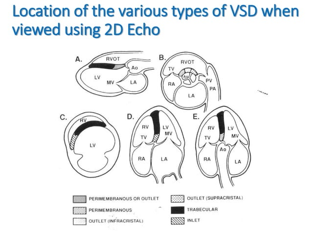Ventricular Septal Defect | PPT
