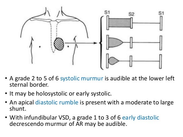 Ventricular Septal Defect
