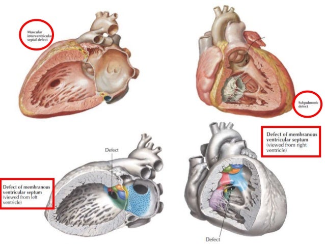 Ventricular Septal Defect