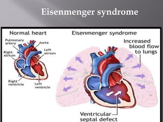 Ventricular Septal Defect with Nursing Management | PDF