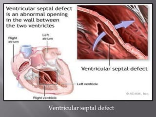 Ventricular Septal Defect with Nursing Management | PDF